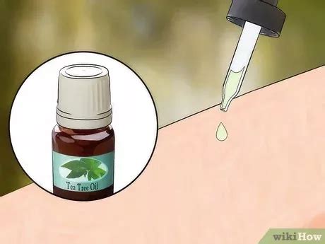 Ways To Get Rid Of Bug Bites WikiHow Bug Bites Bed Bugs Red Bug Bites