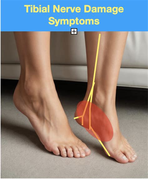 Tibial Nerve Damage Symptoms Discover The Symptoms Of Tibial Nerve Tibial Nerve Damage Symptoms Discover The Symptoms Of Tibial Nerve
