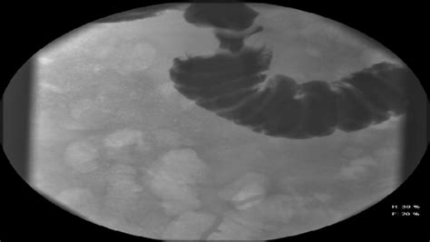 Upper Gastrointestinal Series Revealing The Extent Of The Duodenal