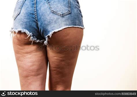 Woman Legs Thighs With Cellulite Skin Problem Body Care Overweight