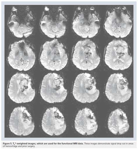 Preoperative Functional MRI Of Motor And Sensory Cortices How Im