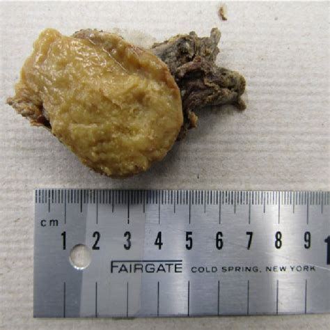 Cut Surfaces Of The Lipoma Are Uniform And Cut Surfaces Of The Lipoma