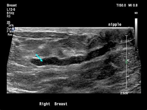 Atlas Of Breast Cancer Early Detection