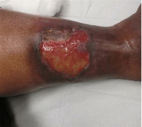 Pyoderma Gangrenosum Decreased Size In Overall Lesion With New Download Scientific Diagram
