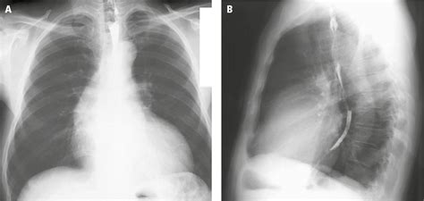 Figure 0310852 Posteroanterior Pa A And Lateral B Chest Radiography Left Ventricular