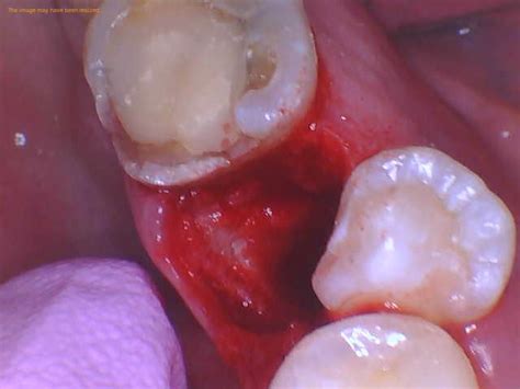 Tooth Broken Root Still In Gums What To Do 1311 Jackson Ave Dental