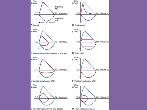 Pulmonary Flow Volume Loops Drpadmesh Pptx