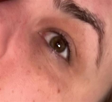 Reactive Lymph Node For 10 Weeks Yellow Skin And Skin Rashes Anyone Experienced Anything