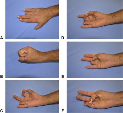 Thumb Reconstruction Using Transfer Of The Ring Finger Without Vascular