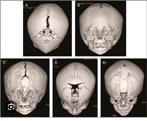 Ct Scans Of An Infants Skull Before And After Surgery To Open Up A Prematurely Fused Skull