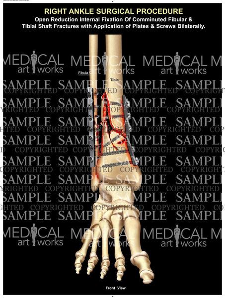 Orif Of Tib Fib Comminuted Shaft Fractures — Medical Art Works