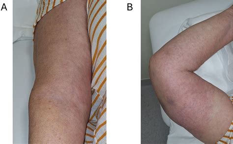 Frontiers Case Report Successful Management Of High Volume