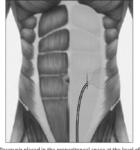 Figure 2 From Preperitoneal Placement Of An Inflatable Penile Prosthesis Reservoir For