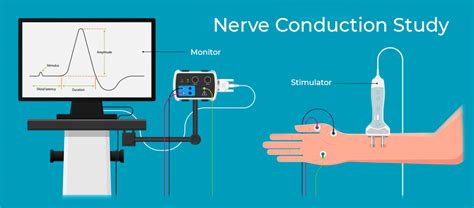 Nerve Conduction Study Video What To Expect At Your Electromyography