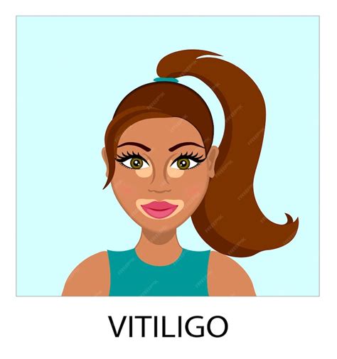 Premium Vector A Portrait Of A Woman With Vitiligo Spots On Her Face