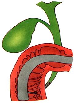 Dr Michael Murray FRACP Patient Information ERCP