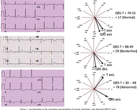 Figure 1 From Prognostic Value Of Frontal Qrs T Angle In Patients