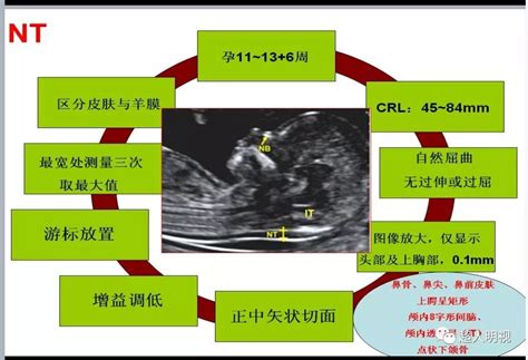 胎儿nt测量