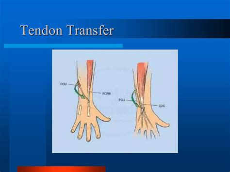 Obstetric Brachial Plexus Palsy Ppt