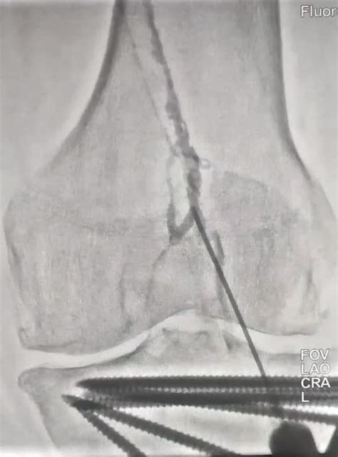 Joel J Ittycheriya On Linkedin Aspiration Thrombectomy Catheter Directed Thrombolysis Patient