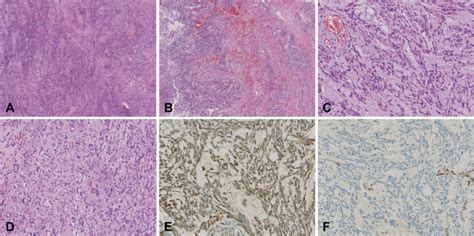 Uterine Myxoid Leiomyosarcoma Identification Of A Novel Plag1 Fusion Partner Pathology