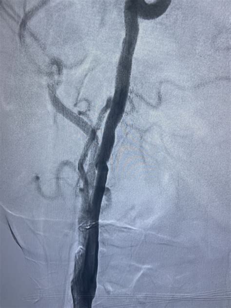 Should We Intervene In Every Carotid Dissection Subacute Minor Ischemic… Prof Dr Gokhan
