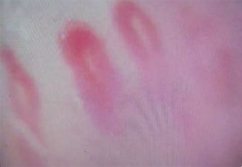 Scleroderma Like Pattern In Nailfold Capillaroscopy Download Scientific Diagram