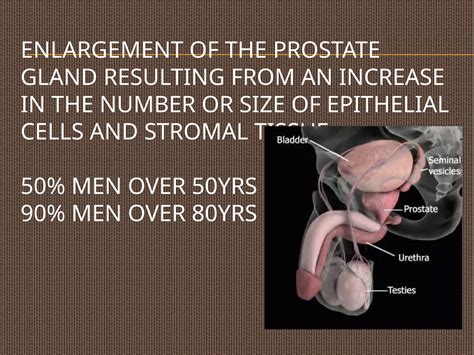 Benign Prostate Hypertrophy Pptxlllllll M Pptx