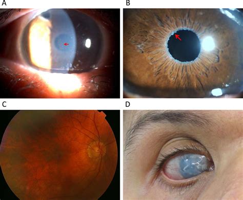 Pseudoexfoliative Glaucoma
