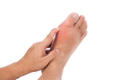 Signs And Symptoms Of Gout