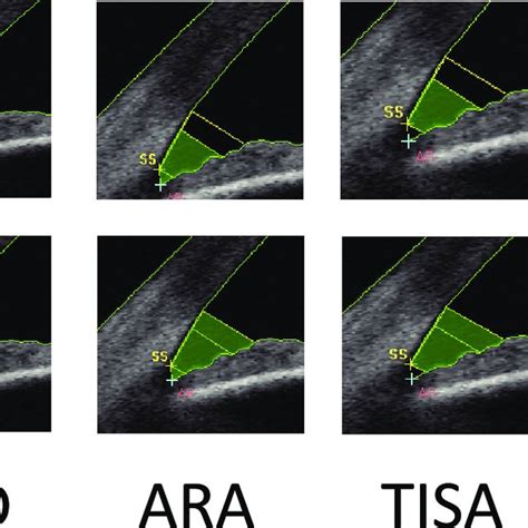 Iridotrabecular Angle Parameters As Measured With The Casia As Oct Download Scientific Diagram