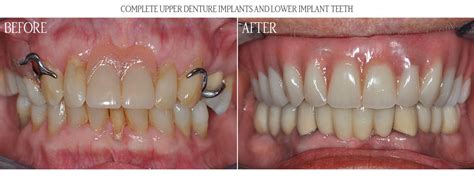 Before And After Gallery Asird American Society Of Implant And
