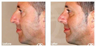 How To Fix The Bump In Your Nose Rhinoplasty OC Marbella