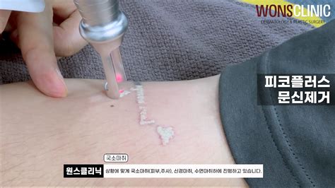 수원문신제거 팔하완 레터링문신 피코플러스 시술동영상 20240702 인계동 원스의원 원스클리닉