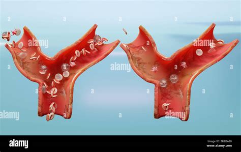 Blutkörperchen Oder Hämoglobinanämie Und Normal Aplastische Anämie