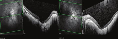Optical Coherence Tomography Images Showing Atrophy Of The Download Scientific Diagram