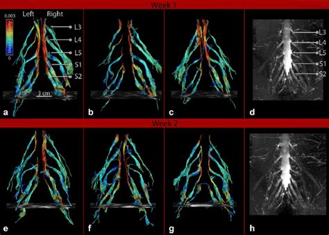 Fiber Tractography Results Of Dti Data Of Scan 1 Scan 2 And Scan 3
