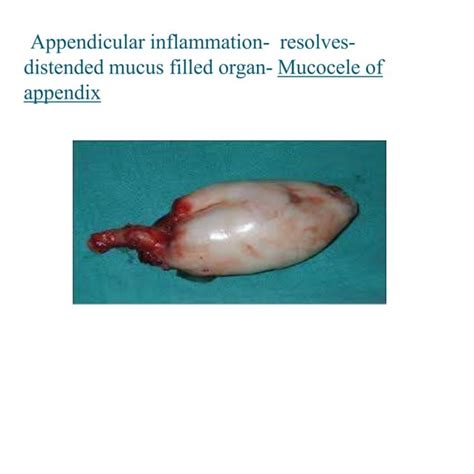 Appendicitis Pptx Digestive Disorders Diseases And Conditions