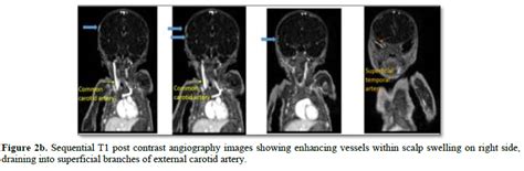 Scitech Management Challenges In Rare Congenital Scalp Arteriovenous Malformation A Case
