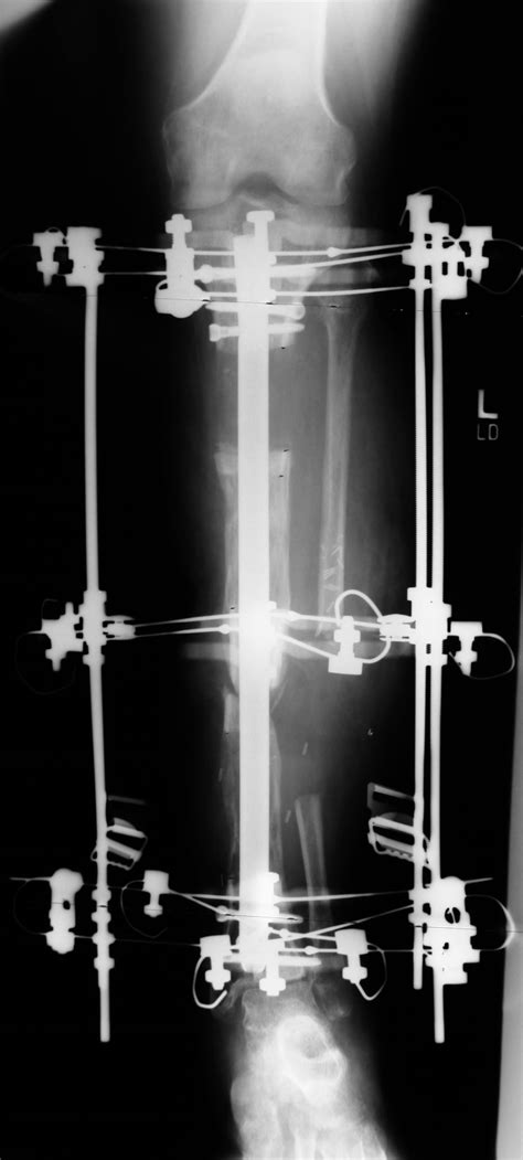 Complex Fracture Tibia Dr Mark Brinker Houston Orthopedic Surgeon