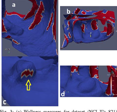 Figure 3 From Colorectal Polyp Segmentation Using Front Propagation On