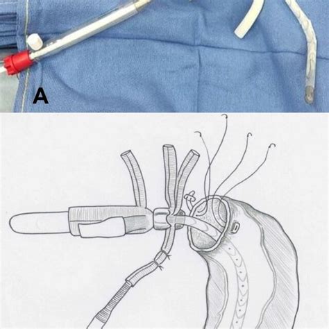 Title The Propensity Score Weighting Analysis Download Scientific Diagram