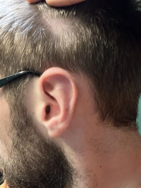 Regrowth R Alopecia Areata