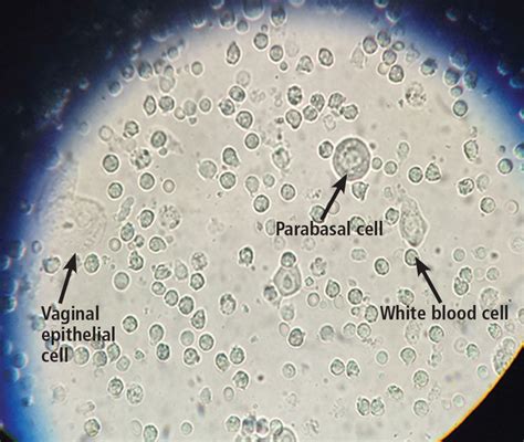 Vaginal Candidiasis Microscopy