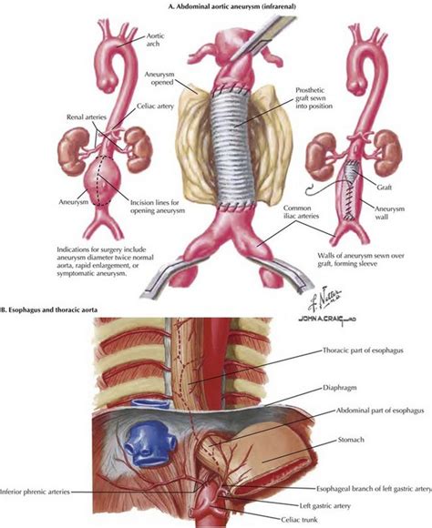 Right Colectomy Basicmedical Key