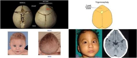 Trigonocephaly Symptoms