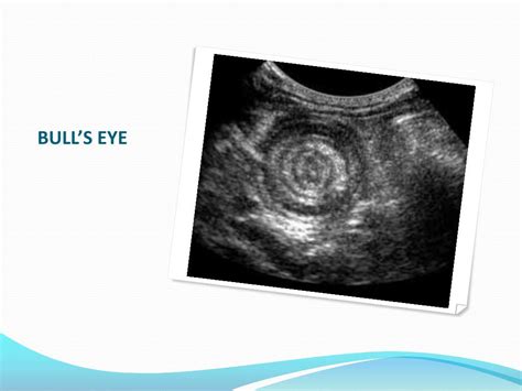 Ppt Intussusception Powerpoint Presentation Free Download Id5749733