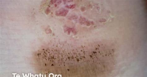 Acral Lentiginous Melanoma Dermoscopy Image
