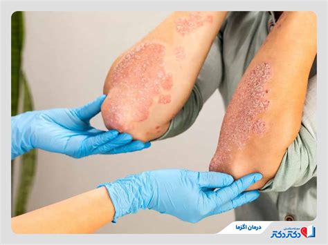 11 روش‌ درمان اگزما انواع درمان‌های پزشکی و خانگی