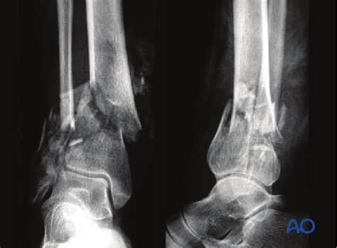 Minimally Invasive Approach To The Distal Tibia